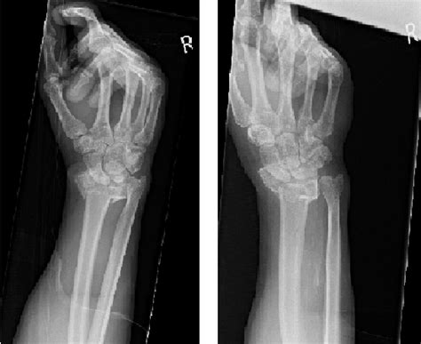 X Ray Right Wrist Pre Orif Showing A Displaced And Comminuted Download Scientific Diagram