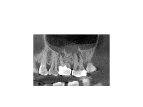 Maxillary Sinus Ppt Ppt Free Download