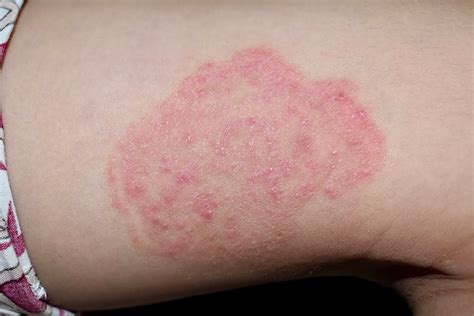 Fungal Infection Tinea The Ssh Clinic