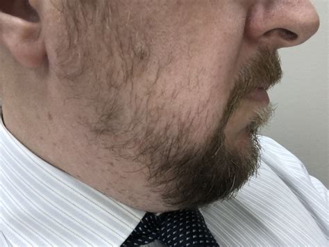38 1st Beard Attempt Low Density Going For Broke 13 Week Update