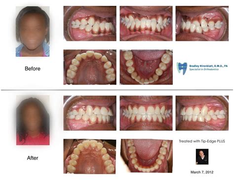 Underbite Braces Malaysia At Katherine Roosa Blog