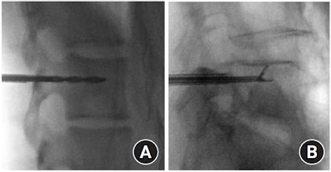 Understanding Spine Tuberculosis A Silent Threat To Your Back
