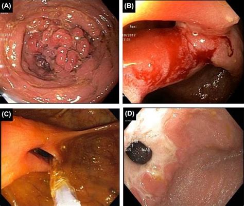 Classification Of Strictures From Crohns Disease Ulcerative Colitis