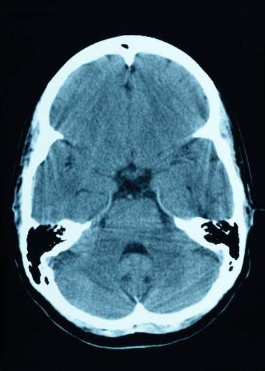 Nhs 111 Wales Health A Z Encephalitis