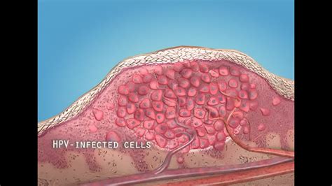 What Do Warts Look Like Inside