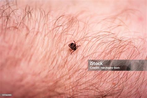 Penyakit Lyme Terinfeksi Kutu Serangga Merangkak Di Kulit Virus