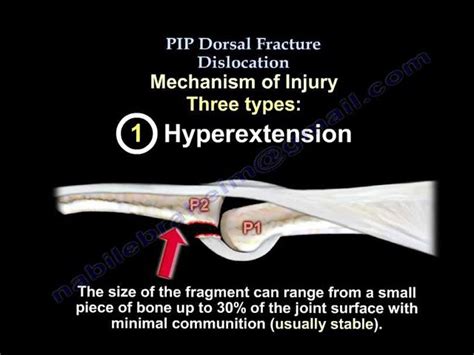 Pip Dislocations Flashcards 60 Off