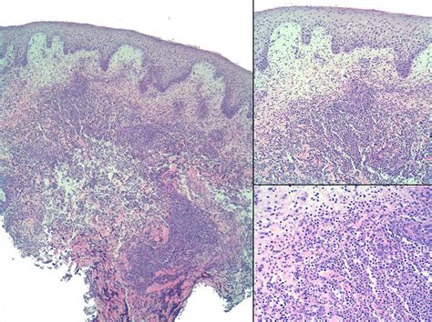 Histologia Do Pioderma Gangrenoso