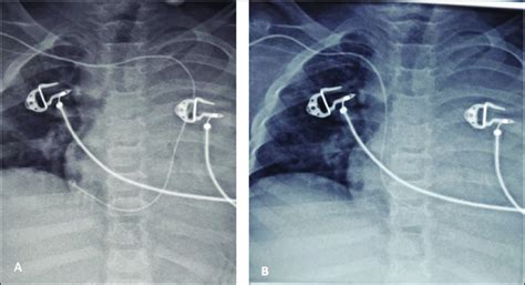 A Ap View Of Cxr Showing A Picc Line Coursing Down The Left Download Scientific Diagram