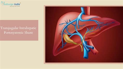 Transjugular Intrahepatic Portosystemic Shunt Cost In India Medsurge India