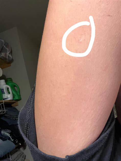 Is The Incision Sight Supposed To Look Like This I Got My Nexplanon Inserted About 27 Days Ago