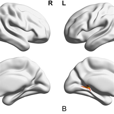 the t statistic maps for comparison of cortical thickness between ad