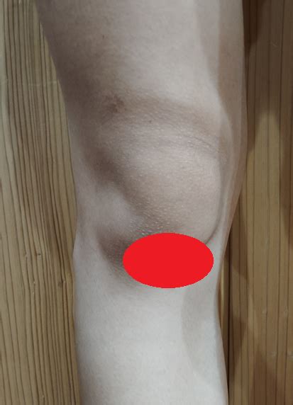 膝が痛い時に「どこの組織」が痛みを出してる？（膝蓋下脂肪体） ー宮崎市清武町のしみず整骨院ー 宮崎市清武町の整骨院 しみず整骨院 腰痛・首痛・膝痛を改善するための「施術」や「運動（体操