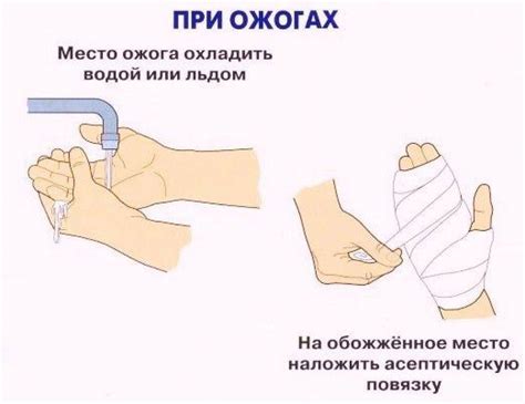 Что делать при ожоге кипятком: первая помощь