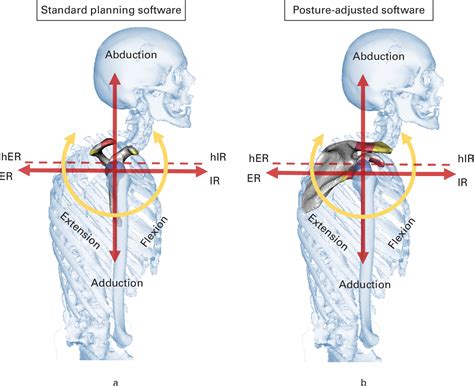 Secec Grammont Award 2024 The Critical Role Of Posture Adjustment For