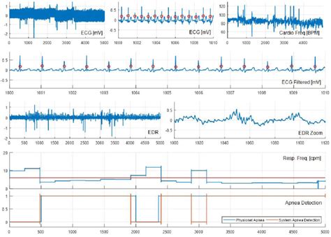 Example Of Qrs Detection Red Dots Ecg Derived Respiration Edr