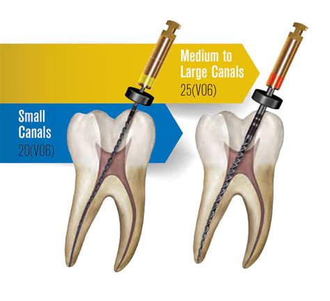 Which Endo File Is Right For Me Clinical Research Dental