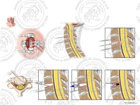 Disc Replacement Vs Discectomy At Angel Singleton Blog