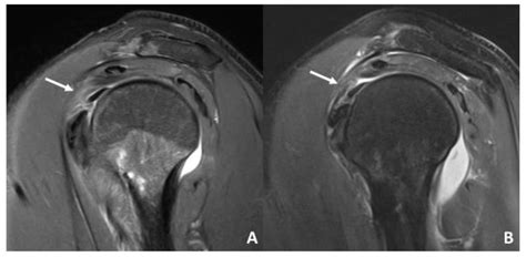 Mri Shoulder Dislocation