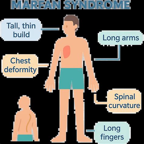 Colorful Educational Graphic Showing Marfan Syndrome Physical Features