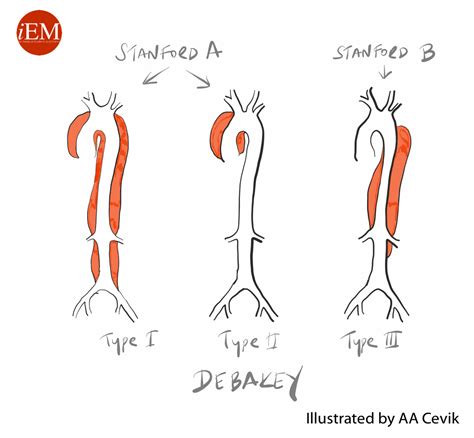 Aortic Dissection Summary Geeky Medics