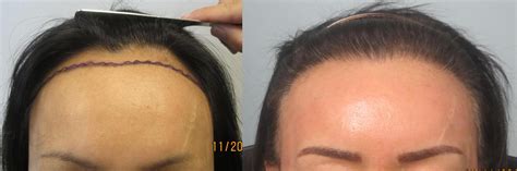 Womens Hair Transplant Before And After Pictures Dr Sean Behnam