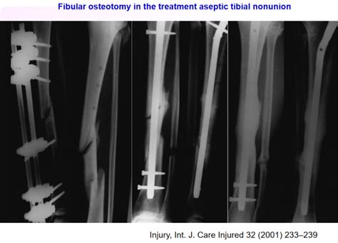 腓骨骨折内固定的取与舍，你选择对吗！ 德医医学 助力医学教育发展！