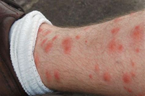 Harvest Mites Bites