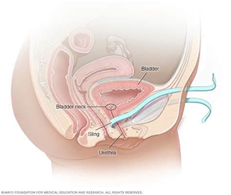 Bladder Sling Surgery
