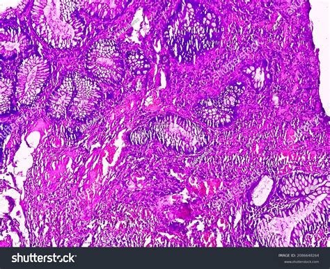 Hyperplastic Polyp Gross Hyperplastic Polyp Gross