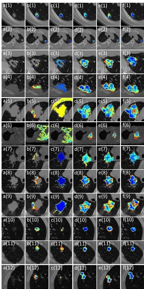 Segmentation Results Of Lung Nodules In Fig 5 Using Different
