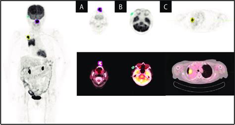 A Focal Uptake Into A Nasal Cavity With Suvmax Up To 10 11 B Download Scientific Diagram