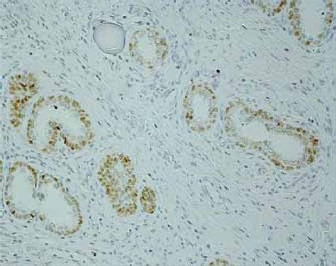 Hotspot Of Intensive P53 Staining At Gleason Score Of 6 100x
