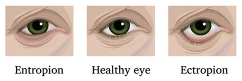 Entropion And Ectropion Pacific Eye And Ear