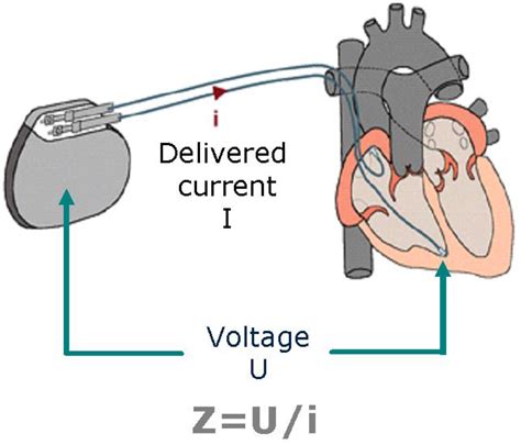 Sensing Pacing Definition At Carmela Schatz Blog