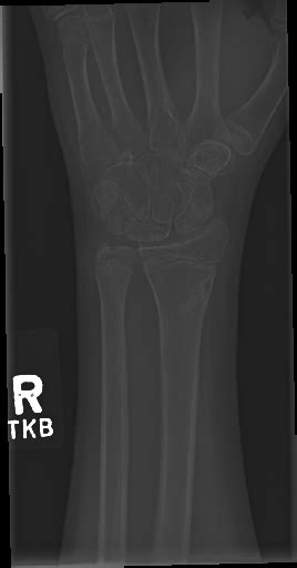 Fracture Wrist Object Detection Dataset V2 2023 04 18 314pm By Fracture Detection And