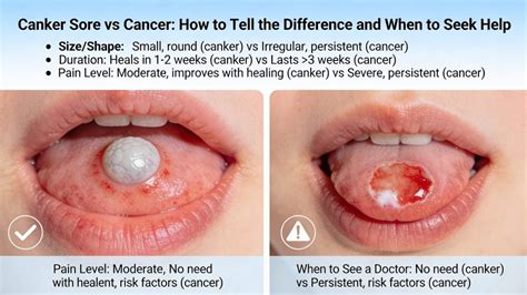 Canker Sore Vs Cancer How To Tell The Difference And When To Seek Help