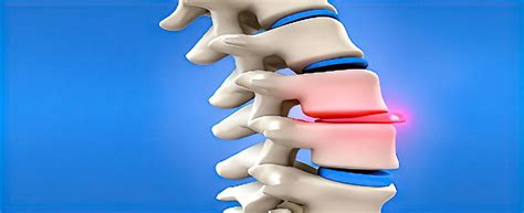 Slipped Disc Life Coach