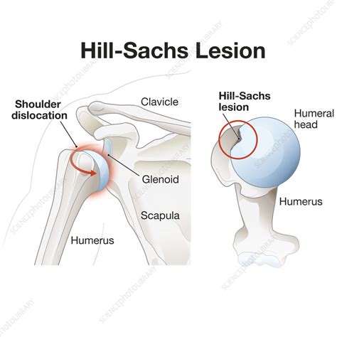 What Is A Hill Sachs Lesion At Elizabeth Simson Blog