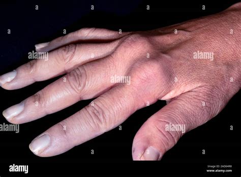 Hand In Crest Syndrome Close Up Of The Swollen Hand Of A 69 Year Old Female Patient With Crest