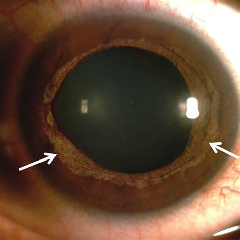 Slit Lamp Image On Diffuse Illumination Of The Left Eye Taken At 3
