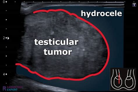 Hydrocele Ultrasound Ultrasound Case 068 • Litfl • Pocus