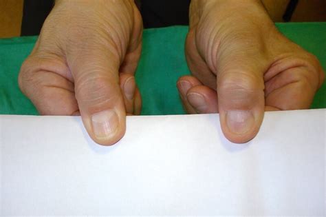 Nerf ulnaire au coude nerf cubital Trajet compression libération Pr Eric Roulot