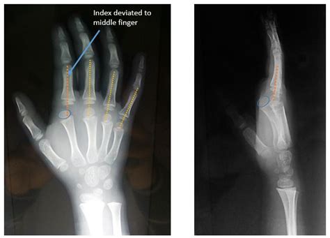 Kaplans Lesion Complex Dorsal Mcp Joint Dislocation Epomedicine