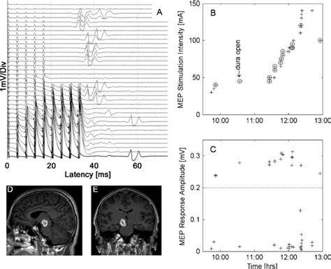 A Mep Monitoring During Surgery On A Patient With Midbrain Cavernoma