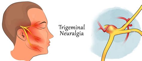 Trigeminal Neuralgia
