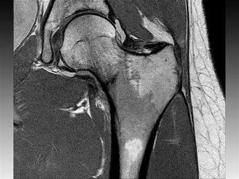 Hip Fracture Mri