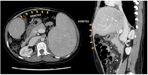 Jcm Free Full Text Long Term Outcomes Of Abdominal Wall