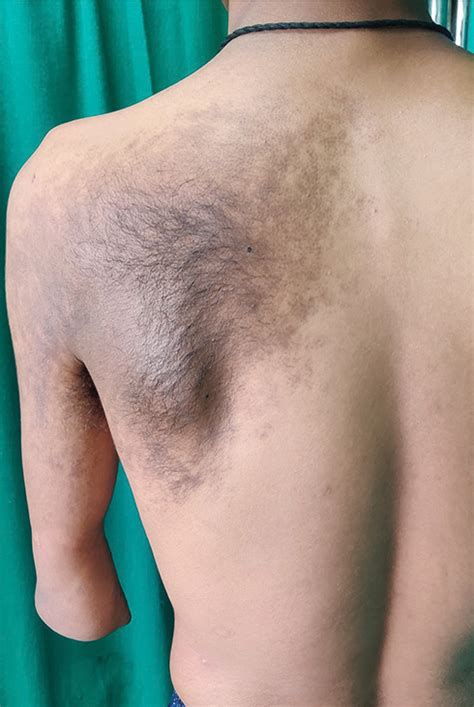 A Pigmented Hairy Nevus With Limb Reduction Cosmoderma