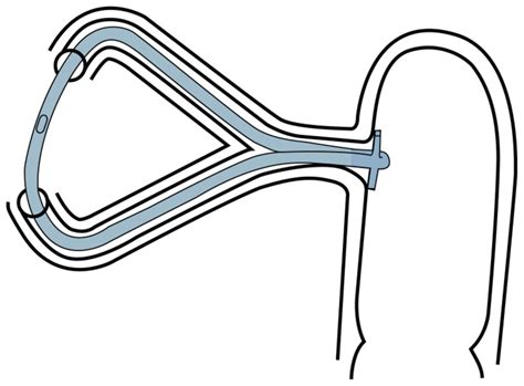 Illustration Showing Components Of The Self Retaining Bicanaliculus